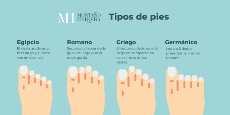 Tipos de pies y criterios de clasificación - Clínica Montaño Herrera