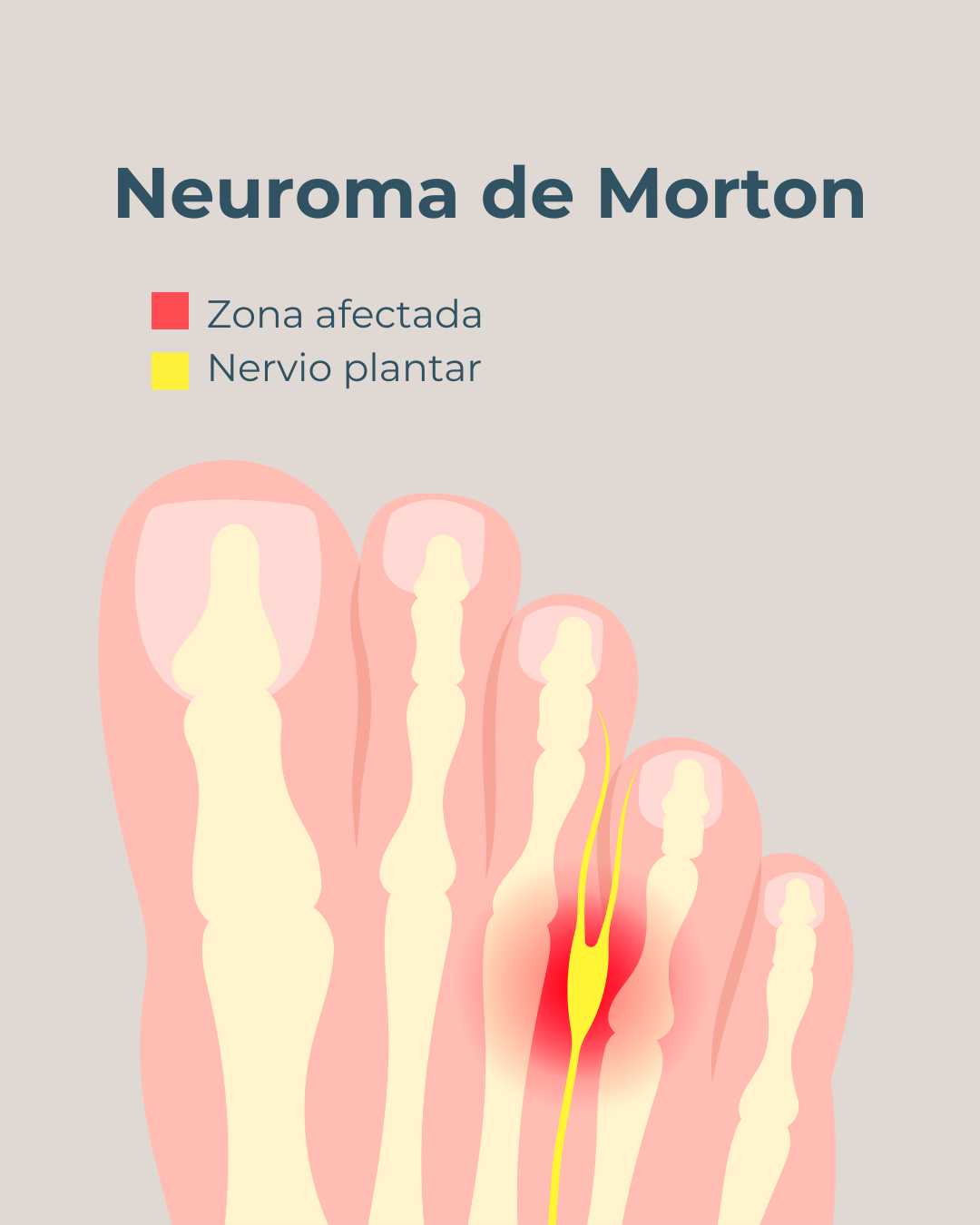 Síntomas del Neuroma de Morton - Clínica del Pie Montaño Herrera